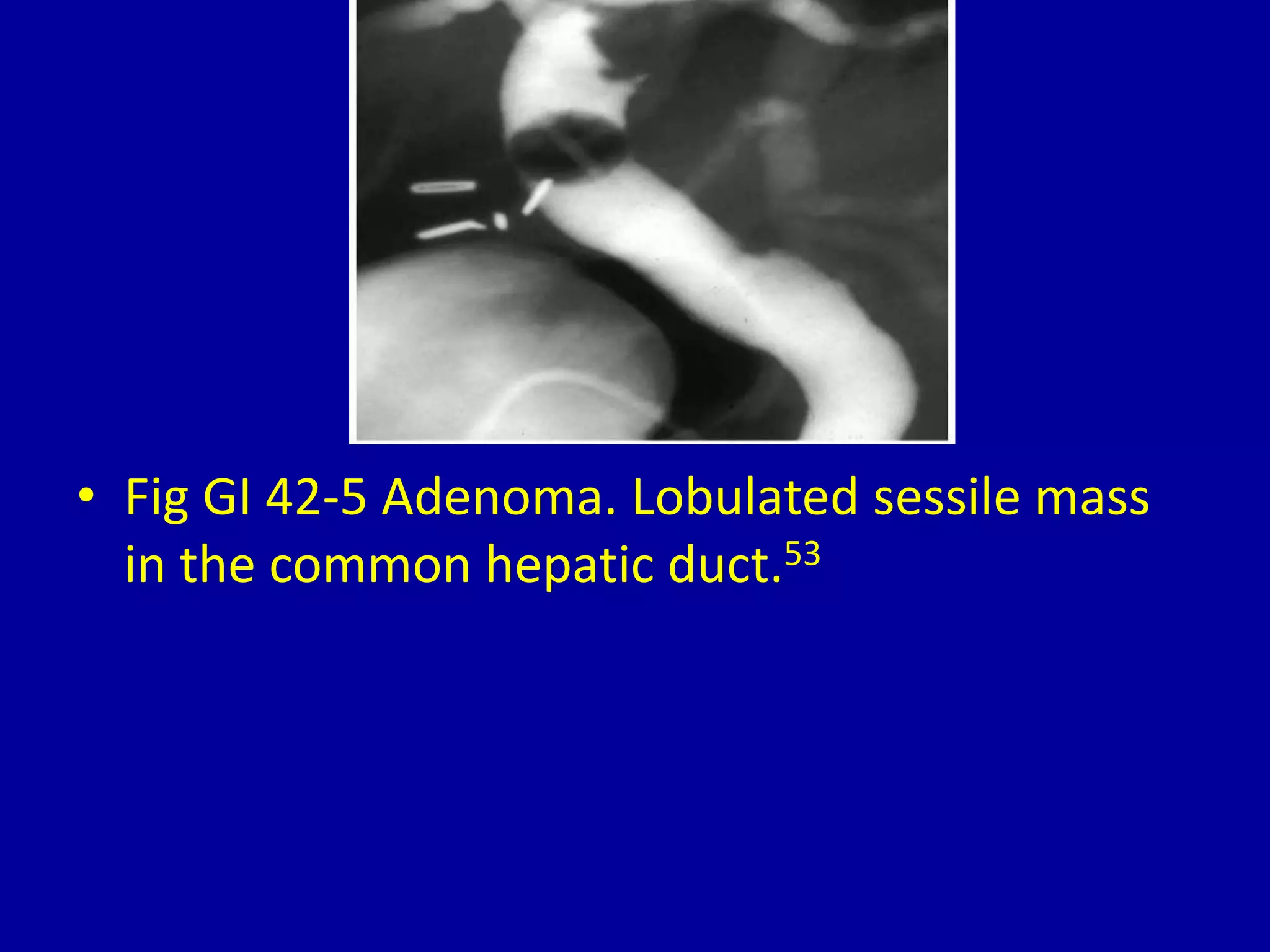 42 filling defects in the bile ducts | PPTX