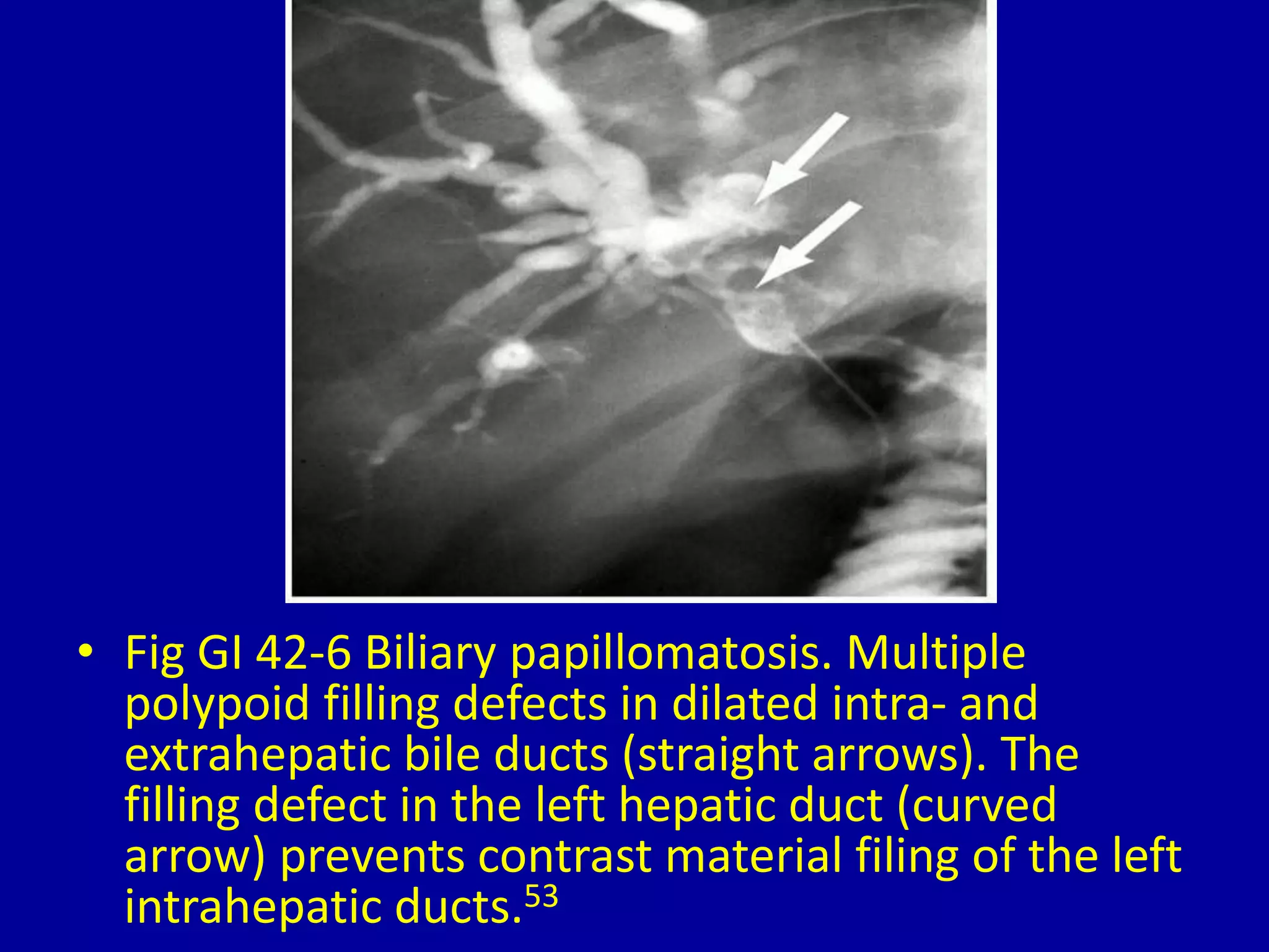 42 filling defects in the bile ducts | PPTX
