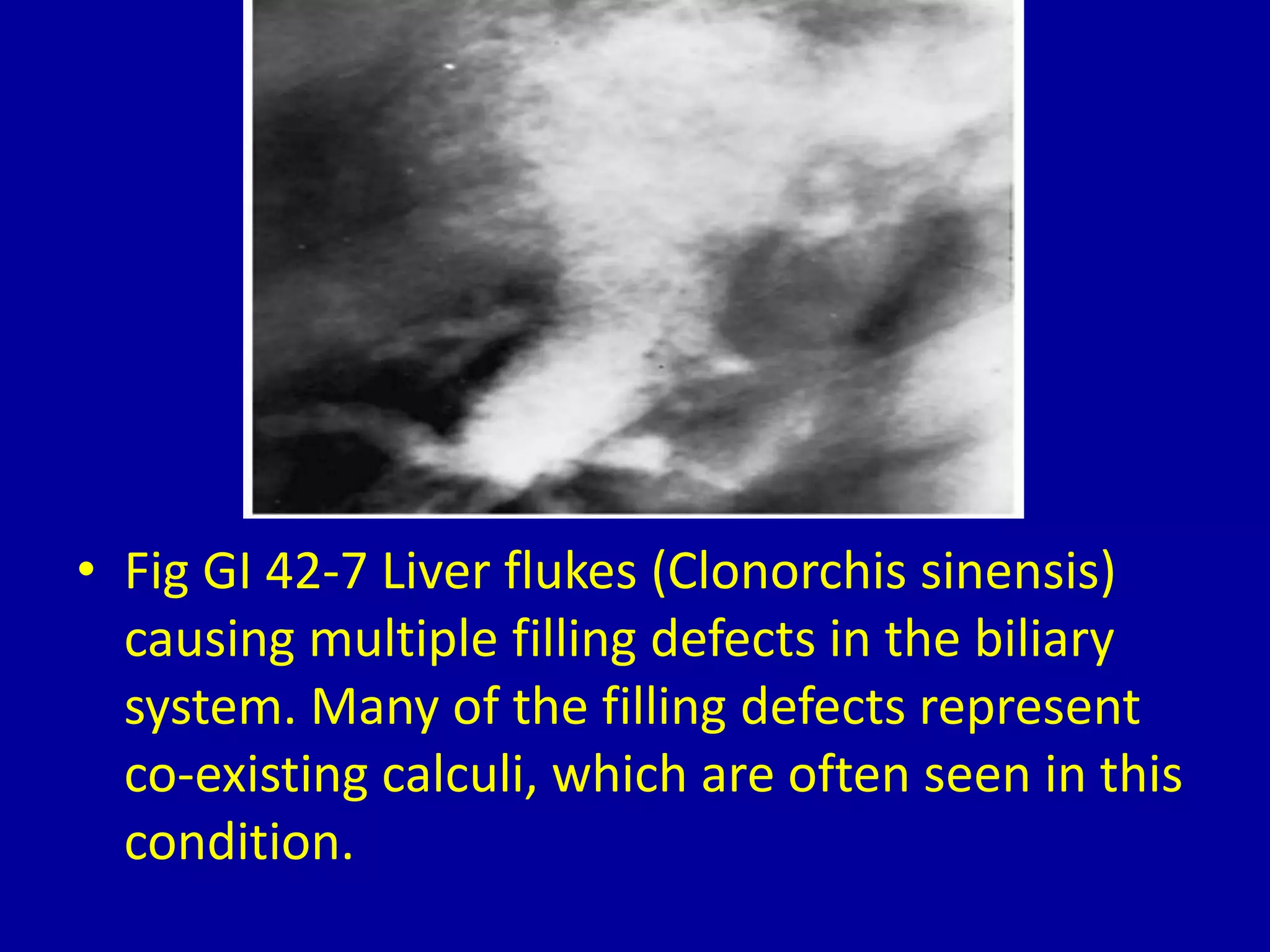 42 filling defects in the bile ducts | PPT