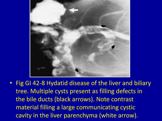 42 filling defects in the bile ducts | PPT