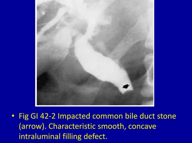 42 filling defects in the bile ducts | PPT