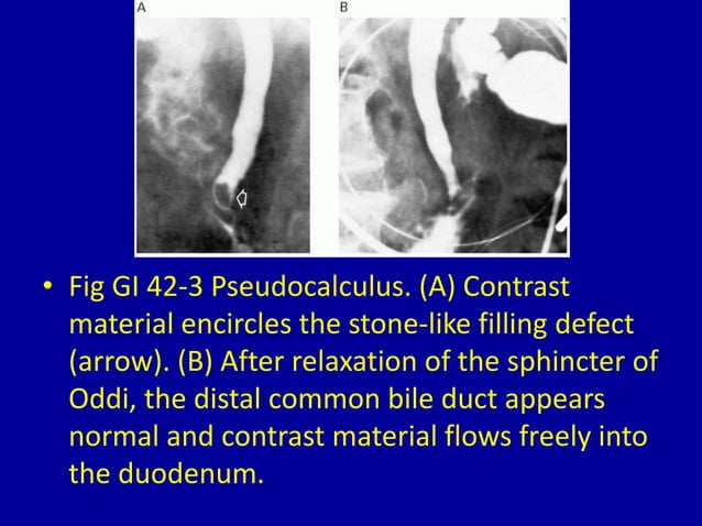 42 filling defects in the bile ducts | PPT