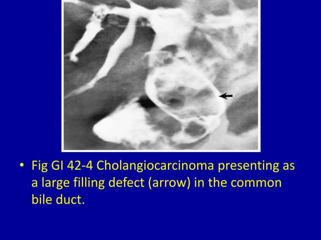 42 filling defects in the bile ducts | PPT