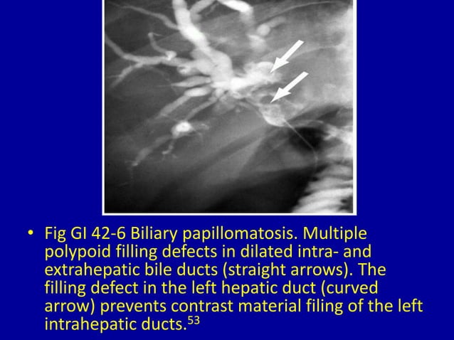 42 filling defects in the bile ducts | PPT