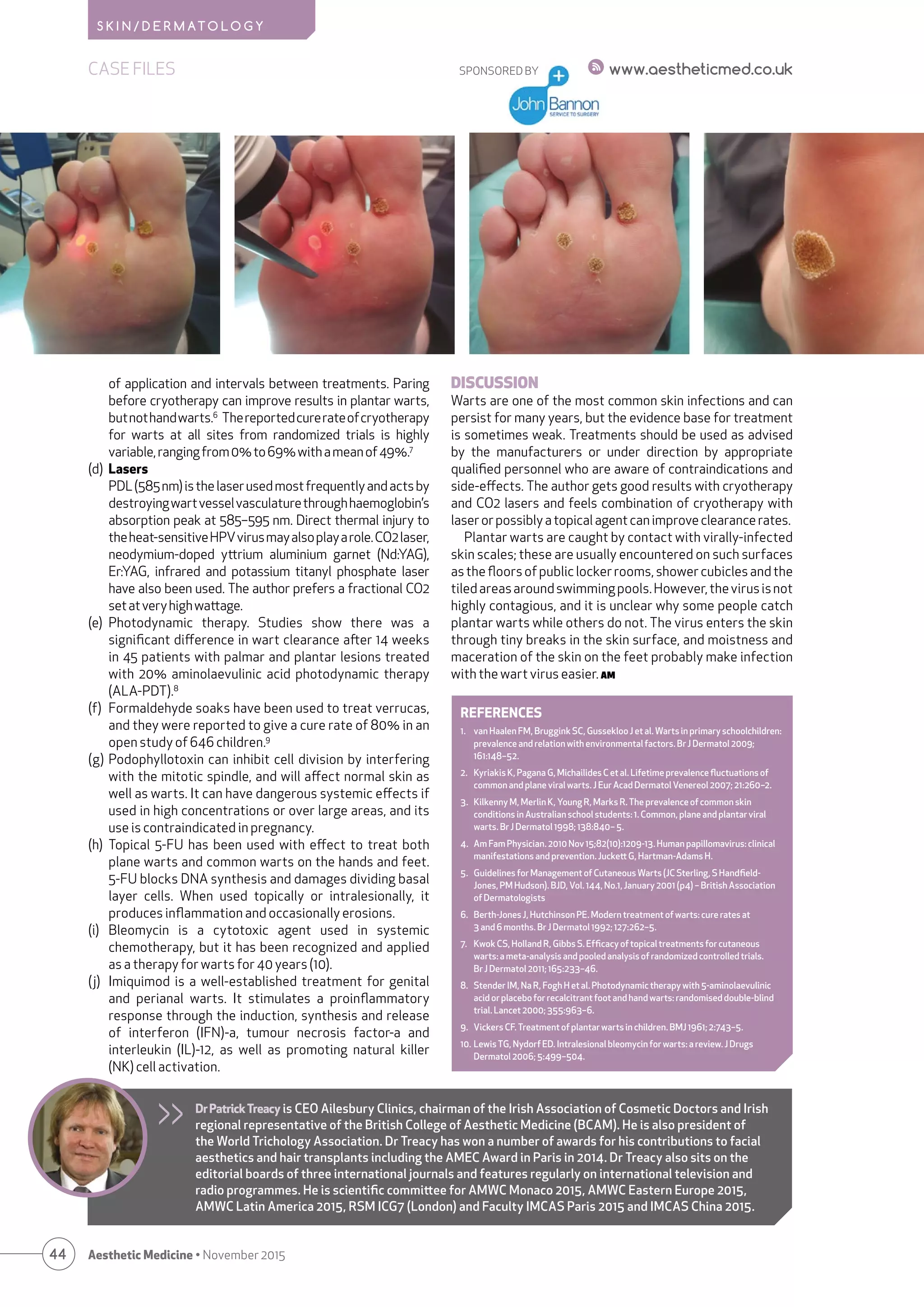 Dr Patrick Treacy treating cutaneous warts | PDF