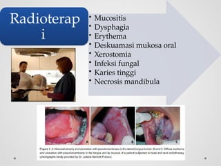 431823179-Xerostomia-Dan-Hiposalivasi-PPT-Fixed.pptx