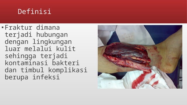 432976175-ppt-fraktur-terbuka_openfracture.ppt