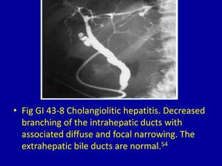 43 bile duct narrowing or obstruction | PPT
