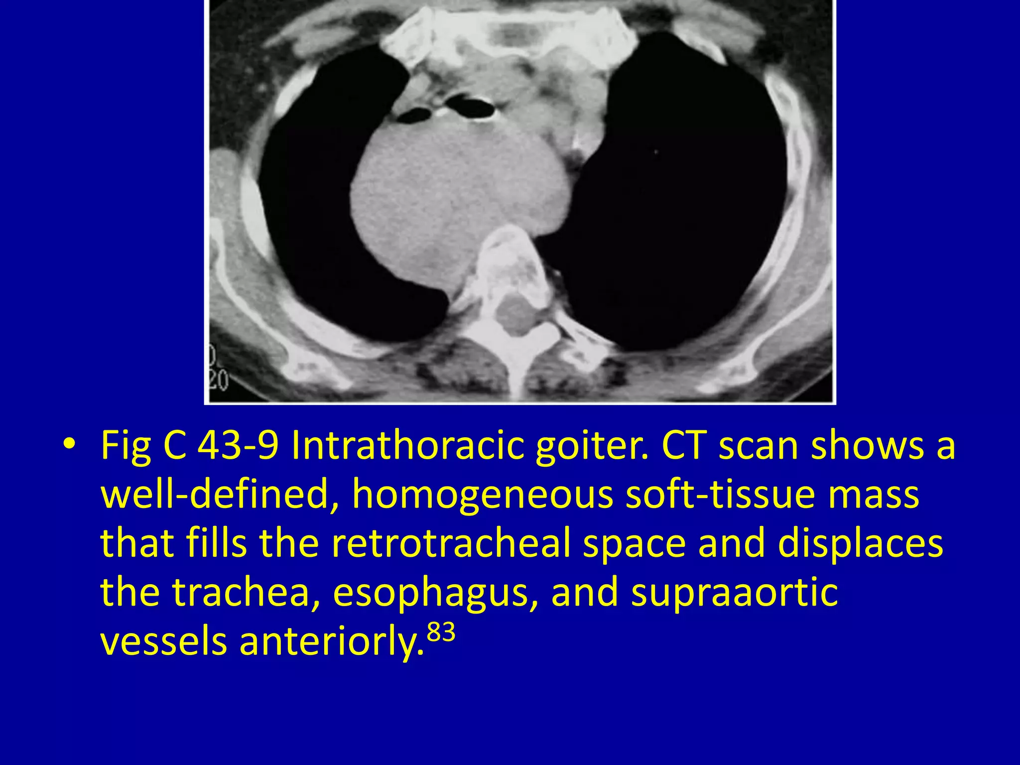 43 retrotracheal space abnormalities | PPTX
