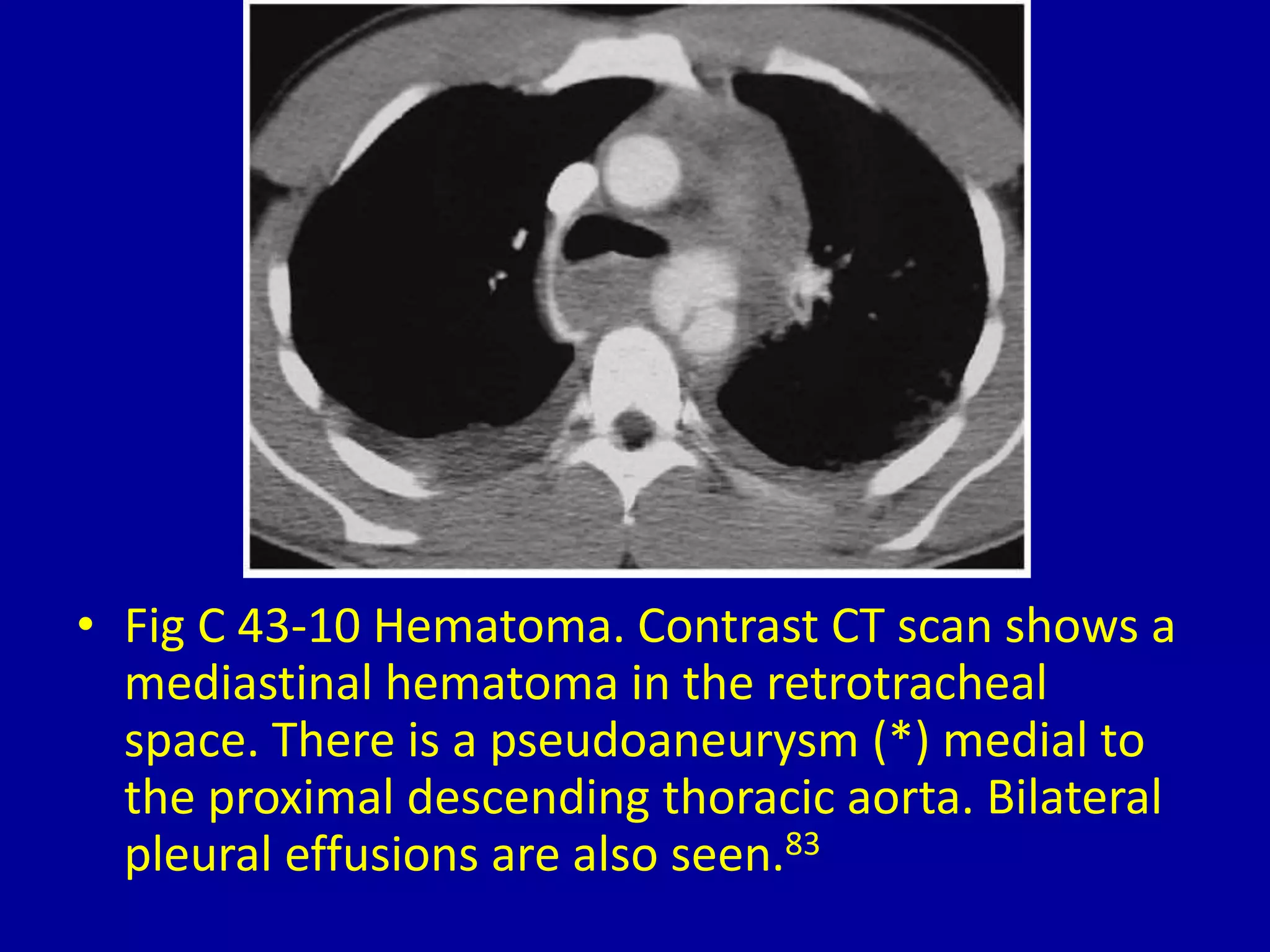 43 retrotracheal space abnormalities | PPTX