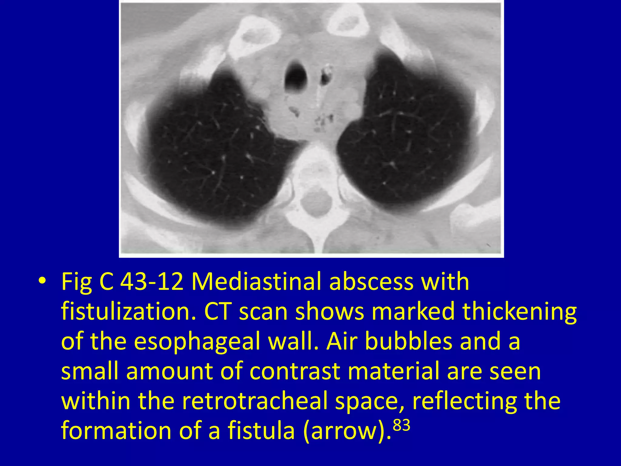 43 retrotracheal space abnormalities | PPTX