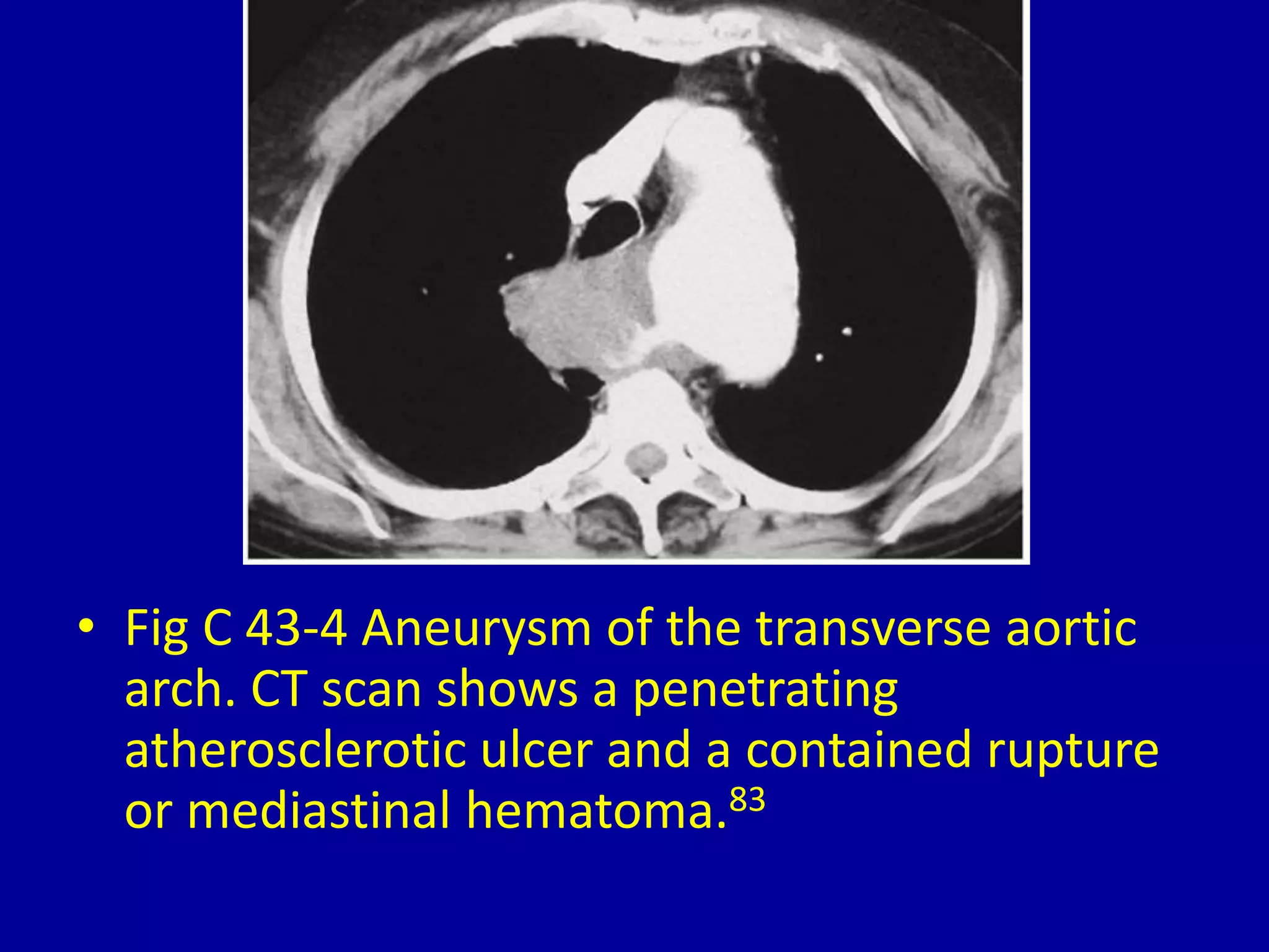 43 retrotracheal space abnormalities | PPTX