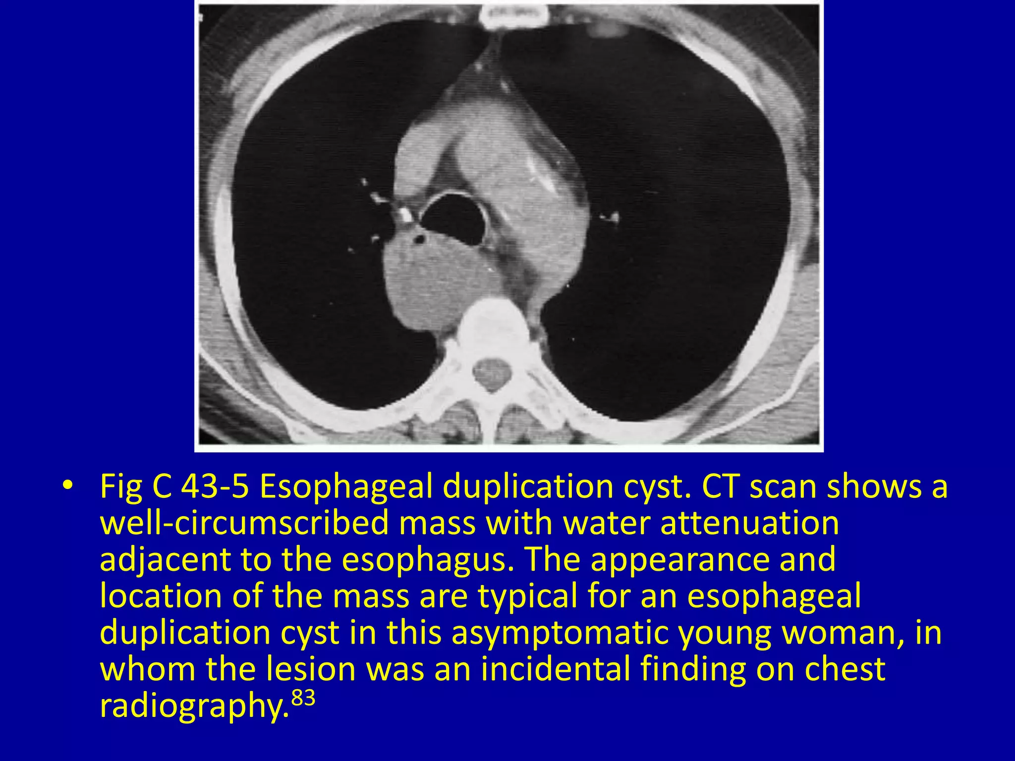 43 retrotracheal space abnormalities | PPTX