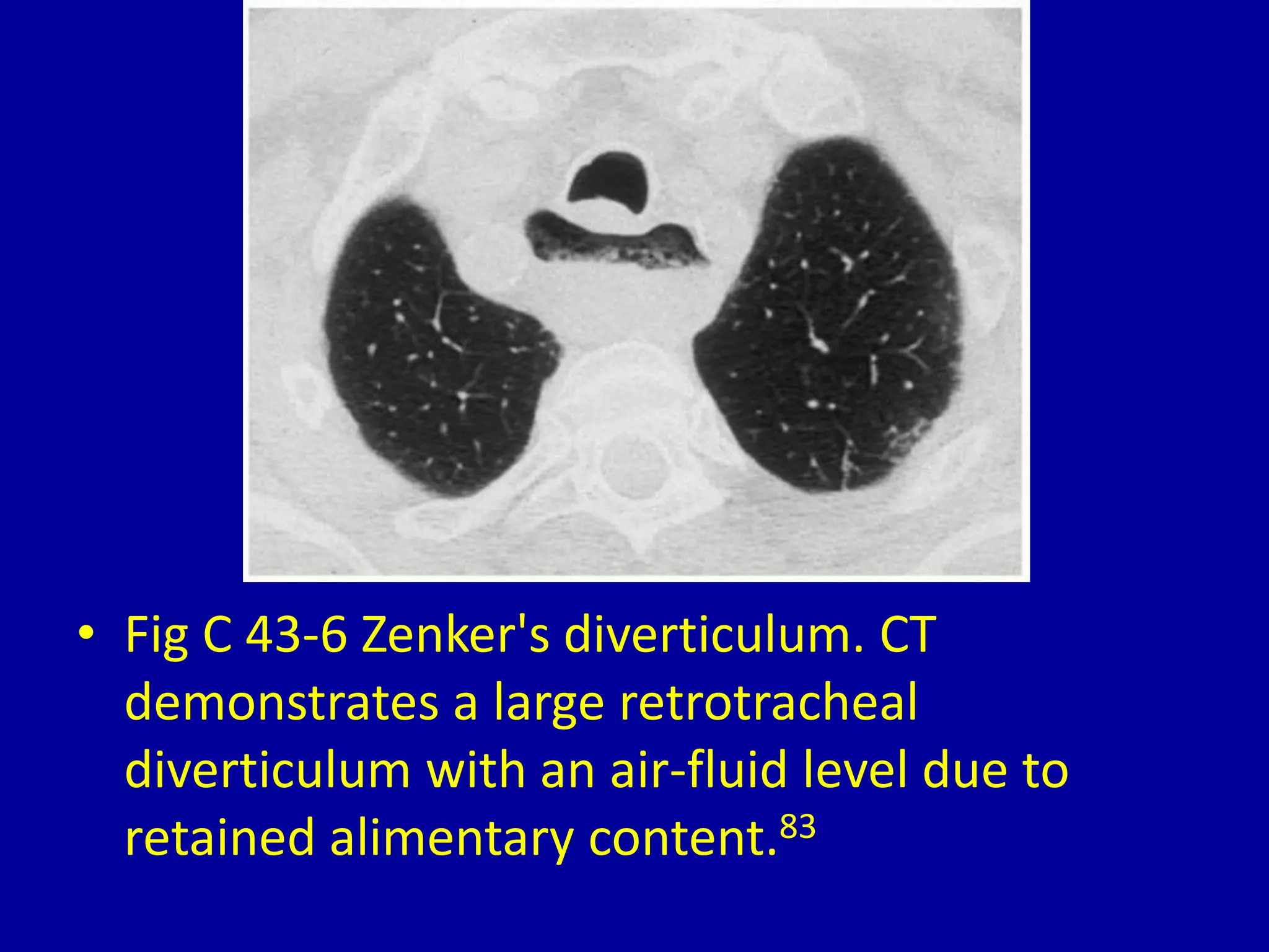 43 retrotracheal space abnormalities | PPTX
