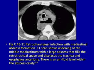 43 retrotracheal space abnormalities | PPTX
