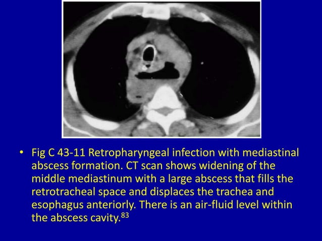 43 retrotracheal space abnormalities | PPTX