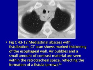 43 retrotracheal space abnormalities | PPTX