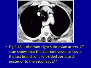 43 retrotracheal space abnormalities | PPTX
