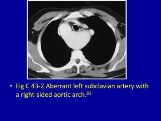 43 retrotracheal space abnormalities | PPTX