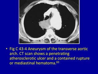 43 retrotracheal space abnormalities | PPTX