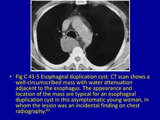 43 retrotracheal space abnormalities | PPTX