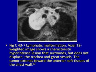 43 retrotracheal space abnormalities | PPTX