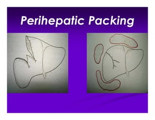 Liver trauma conference presentation | PPT