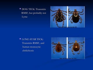 Rocky mountain fever symptoms diagnosis and management | PPT