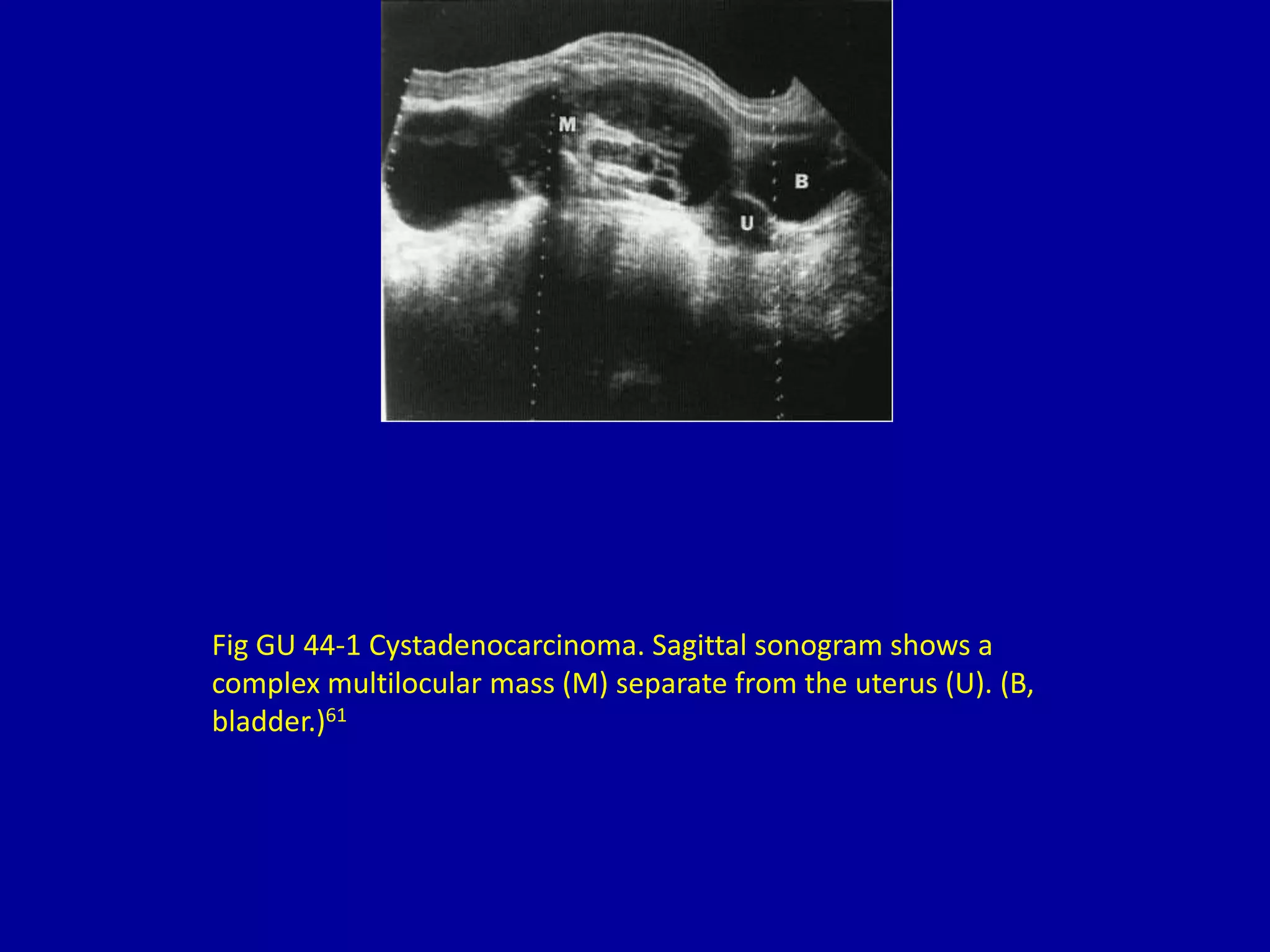 44 complex pelvic masses | PPTX