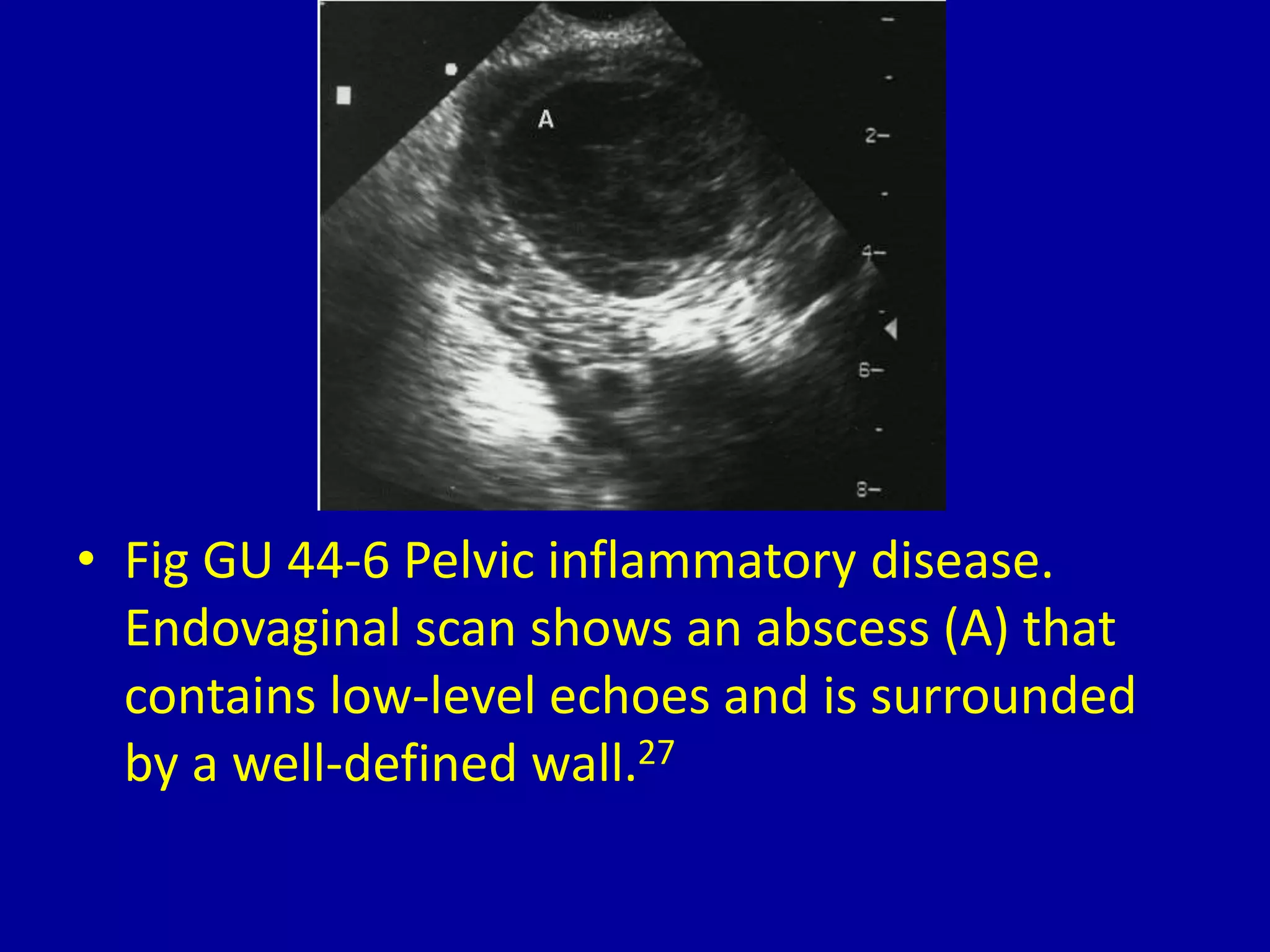 44 complex pelvic masses | PPT