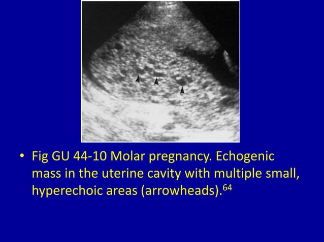 44 complex pelvic masses | PPT