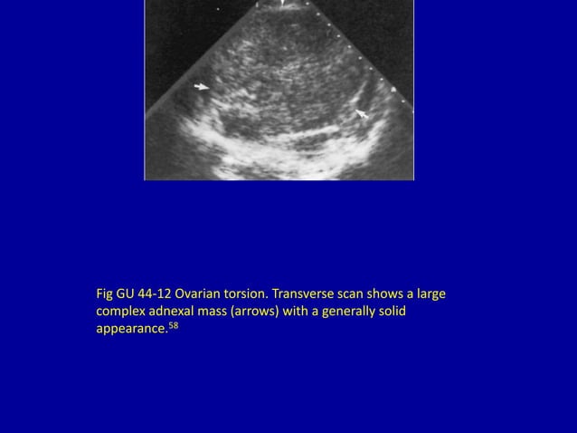 44 complex pelvic masses | PPT