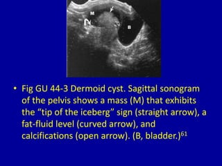 44 complex pelvic masses | PPTX