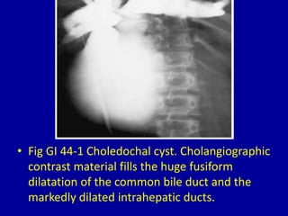 44 cystic dilatation of the bile ducts | PPTX