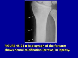Reticulum Cell Sarcoma X Ray