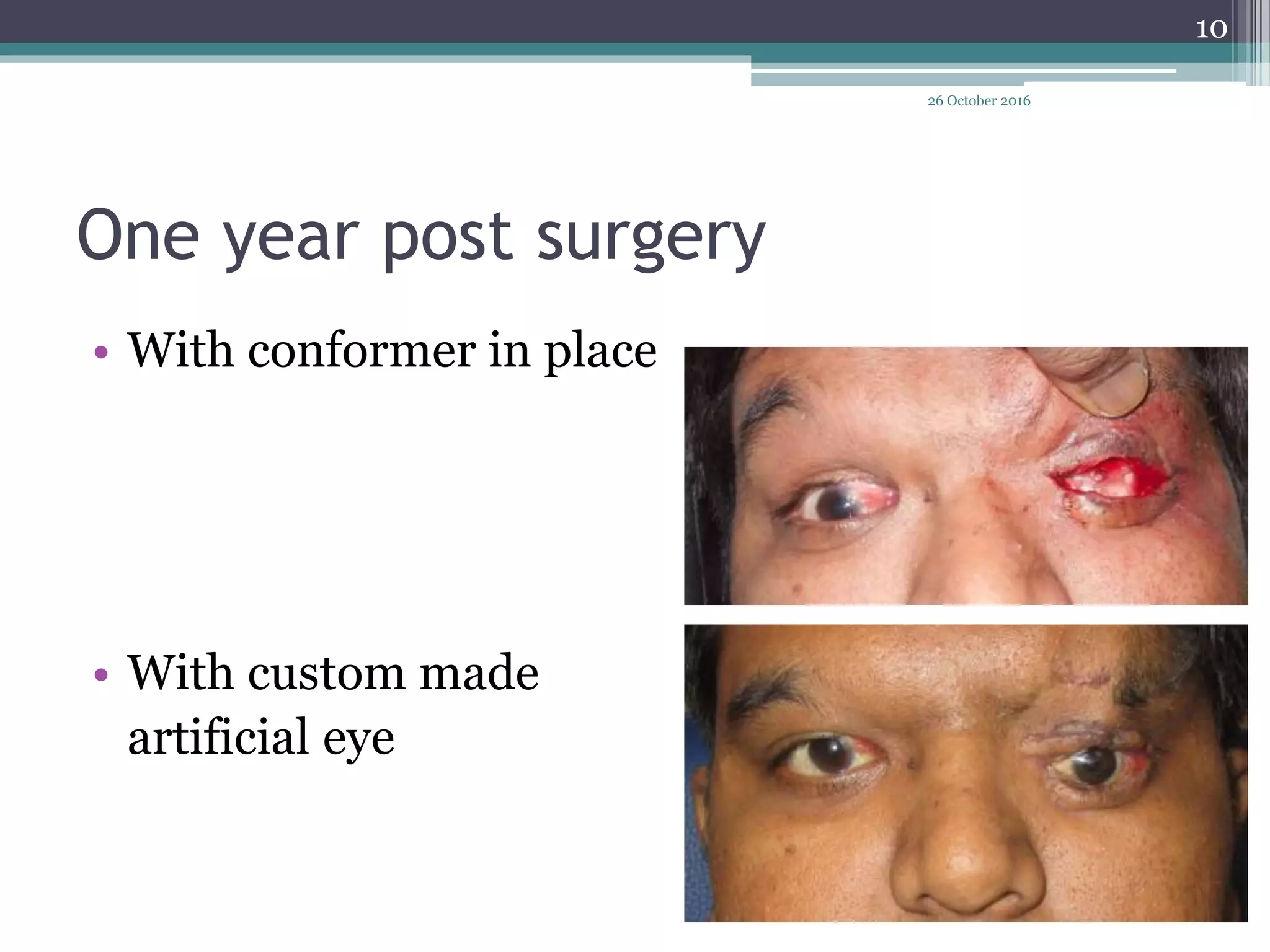 Multiple Layered Free Grafts For The Management Of Cryptophthalmos ...