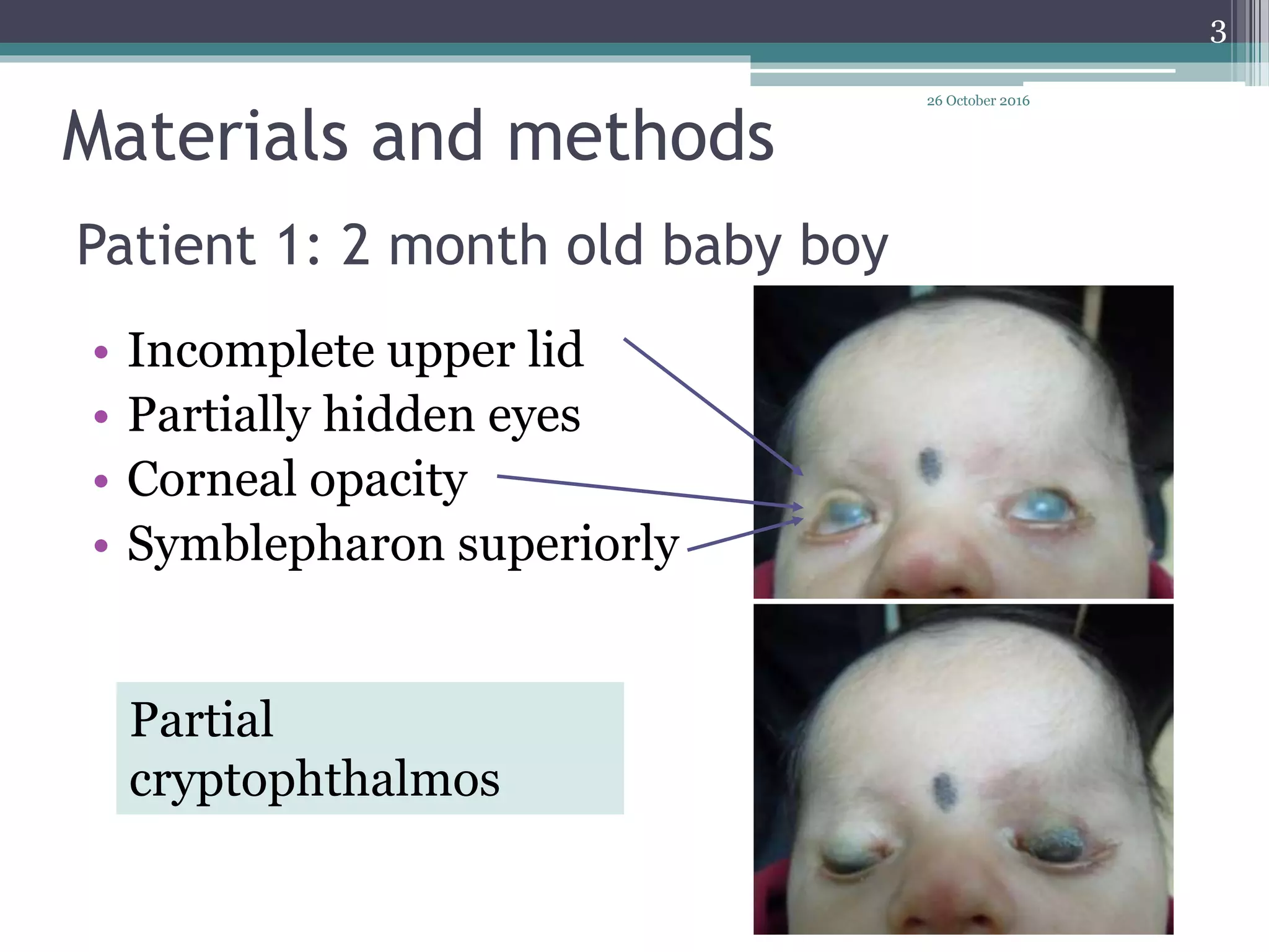 Multiple Layered Free Grafts For The Management Of Cryptophthalmos ...
