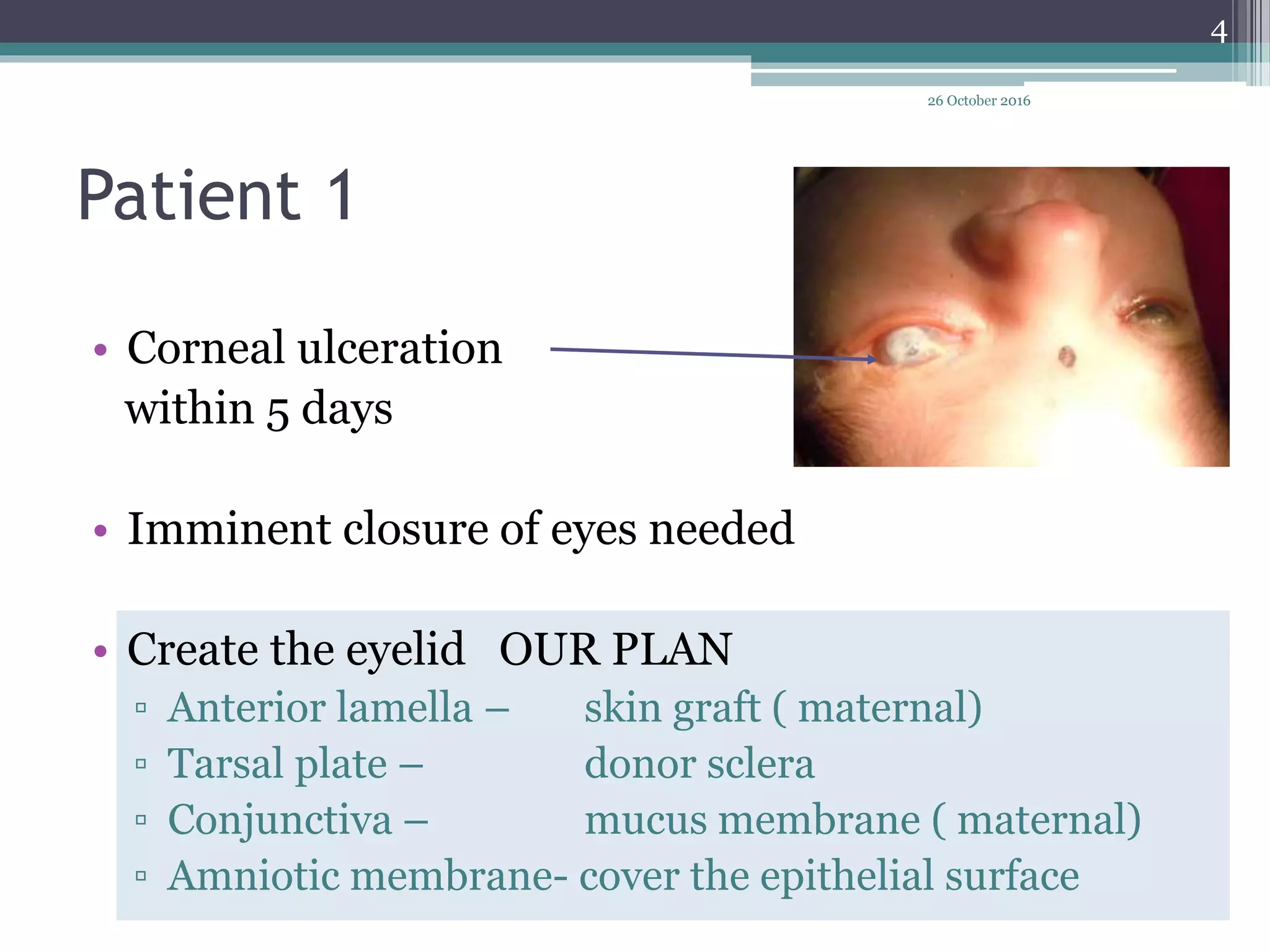 Multiple Layered Free Grafts For The Management Of Cryptophthalmos ...