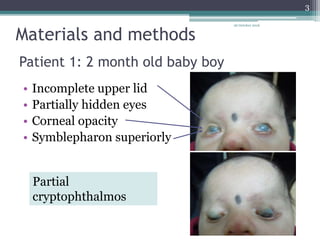 Multiple Layered Free Grafts For The Management Of Cryptophthalmos ...