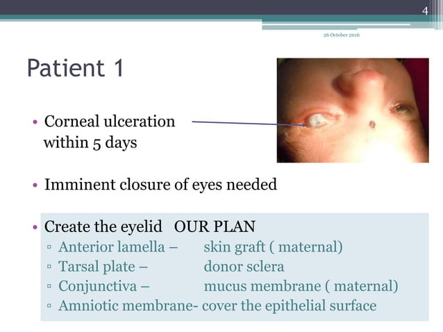 Multiple Layered Free Grafts For The Management Of Cryptophthalmos ...