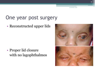 Multiple Layered Free Grafts For The Management Of Cryptophthalmos ...