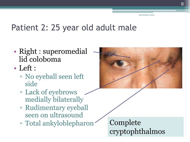 Multiple Layered Free Grafts For The Management Of Cryptophthalmos ...
