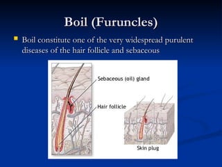 Purulent infection, Acute and Chronic . | PPT