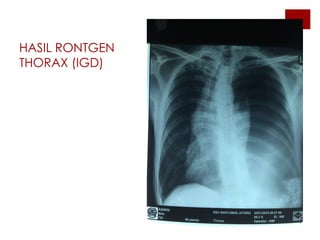 451725480-65478793-Pneumothorax-Final-ppt.ppt