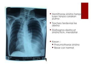 451725480-65478793-Pneumothorax-Final-ppt.ppt