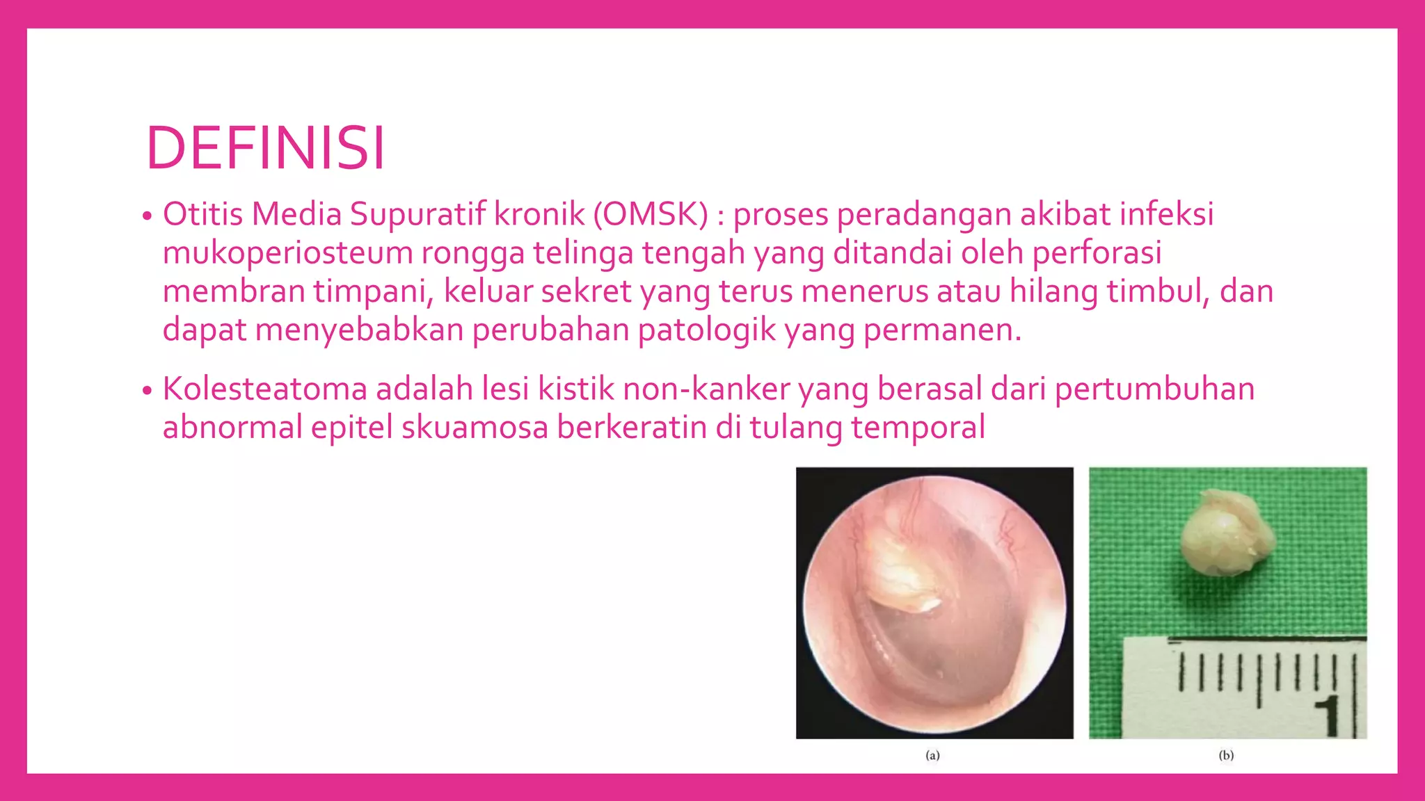 otitis media supuratif kronik tipe maligna | PPTX