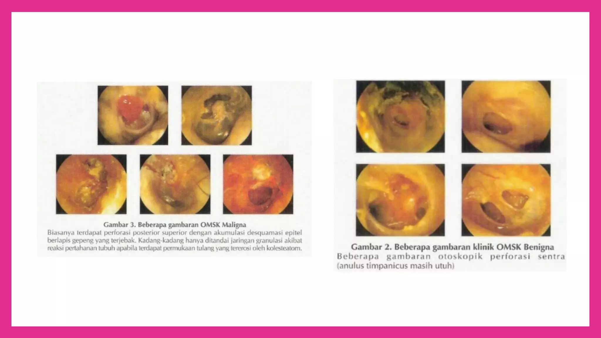 otitis media supuratif kronik tipe maligna | PPTX