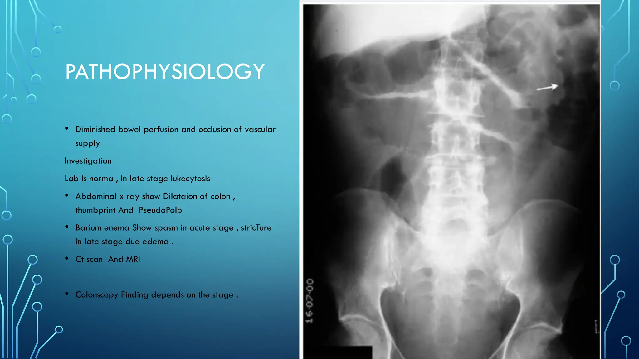 BowelIschemiaPresentationByMaiBashir.pptx