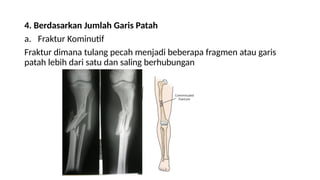 458046020-Klasifikasi-Fraktur tulang .pptx