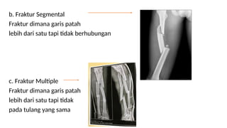 458046020-Klasifikasi-Fraktur tulang .pptx